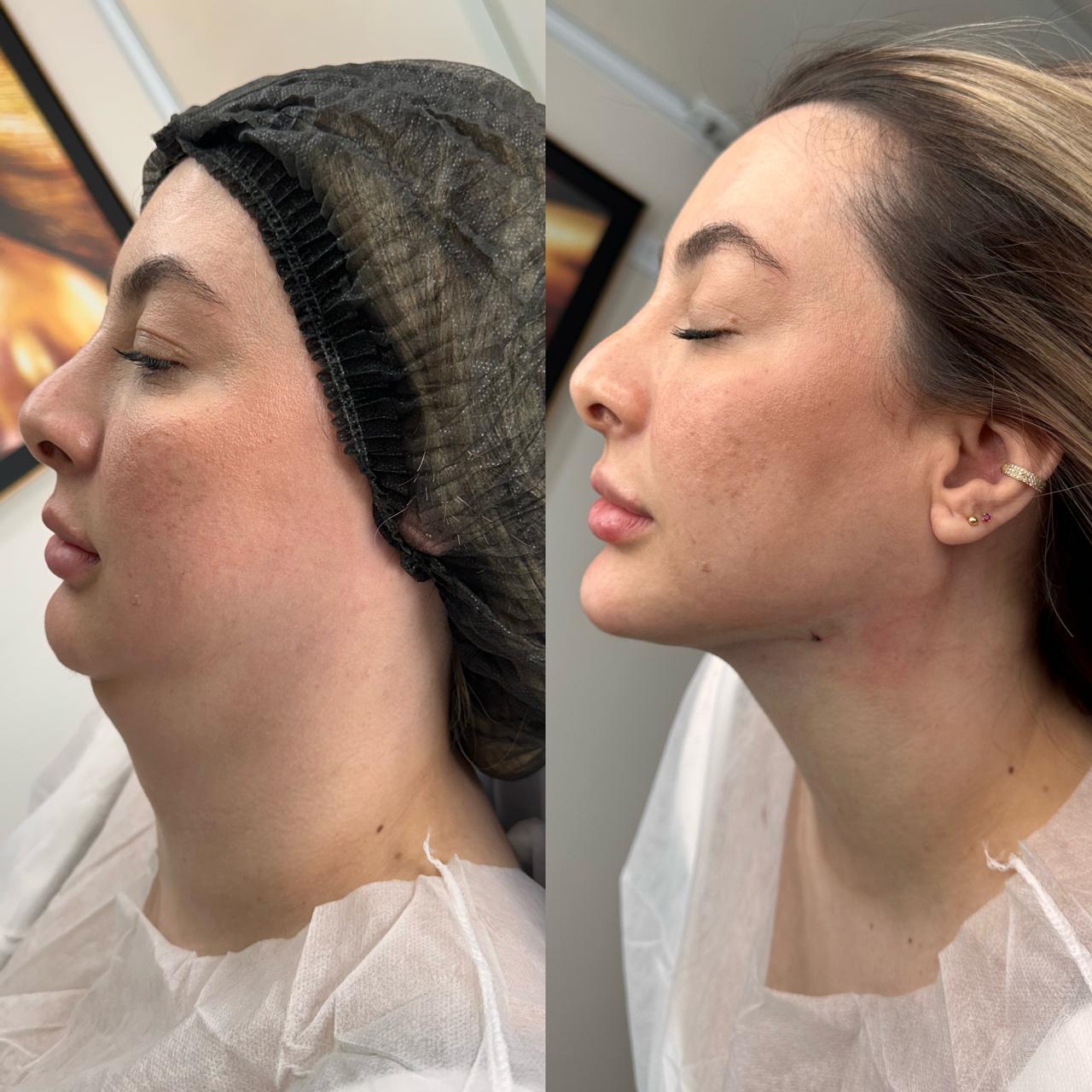 Lipo de Papada ou Bioestimuladores? Qual é a Melhor Opção para Você?