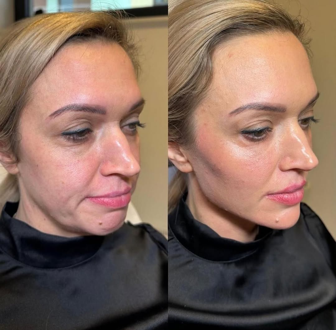 Plasma Rico em Fibrina: O Rejuvenescimento Natural da Pele